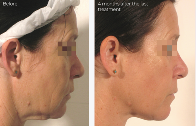 Lumenis OptiLIFT and OptiLIGHT | Lange Eye Care and Associates
